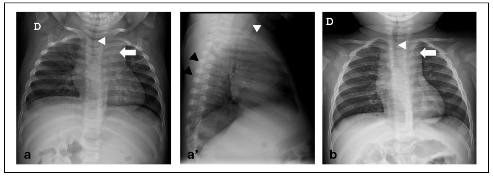 Anatomía De La Radiografía De Tórax Lateral Estructuras Básicas En