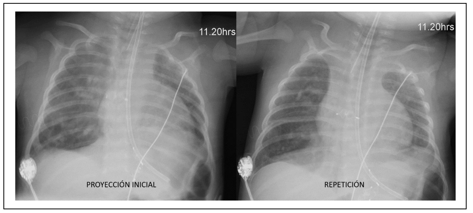 Anatomía Del Tórax Por Rayos X ABC Radiografía De Tórax